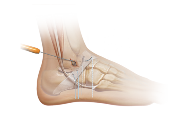Best Foot & Ankle Surgeon in San Francisco | Dr. James Chen