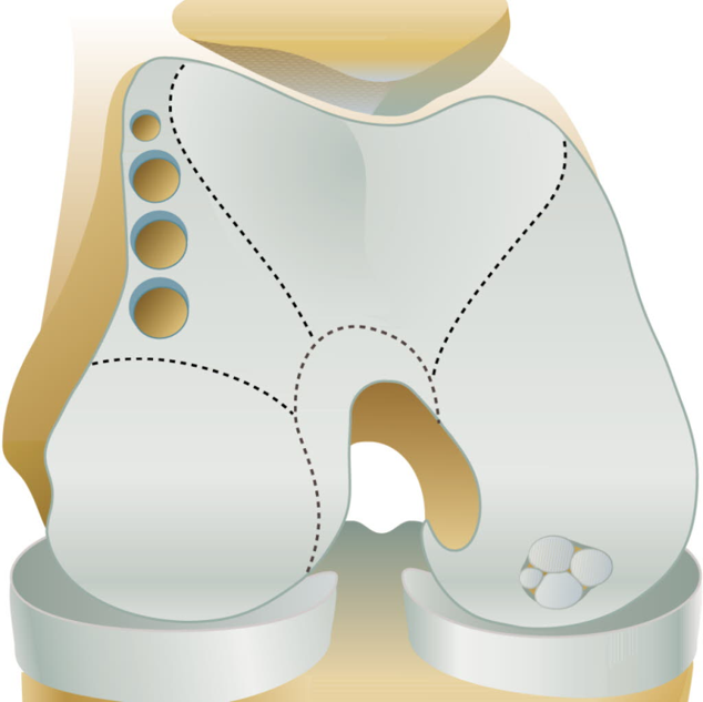Top Orthopedic Surgeon | San Francisco | OATS Procedure