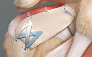 Get Faster Healing with Top Orthopedic Surgeon | Bay Area