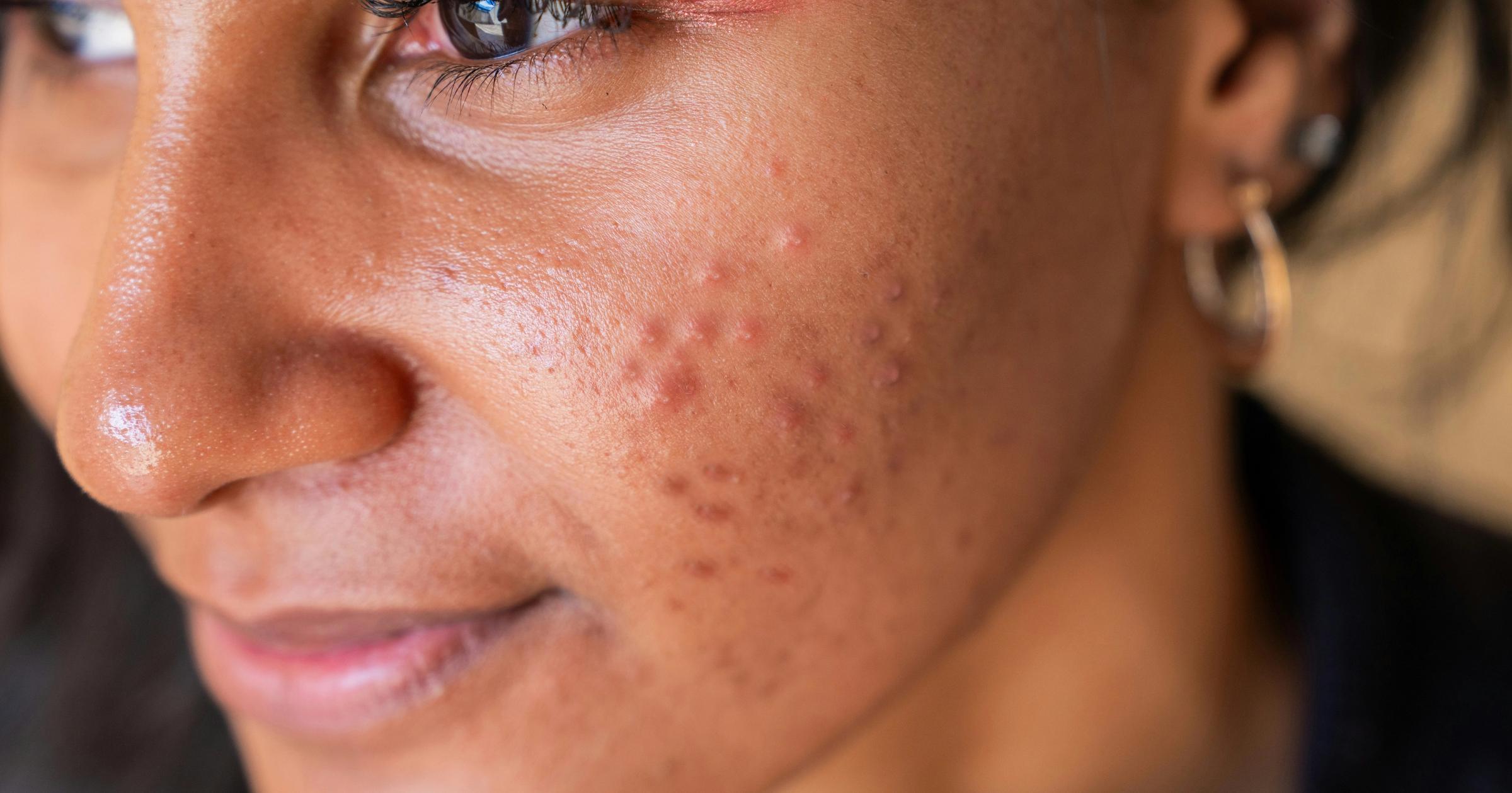 Automated Acne Severity Scoring at Nolla