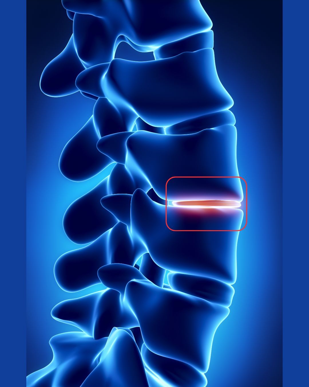 Disc Degeneration and Back Pain in Mesa, Tempe, Chandler and Gilbert ...