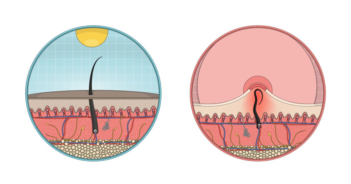 What Causes Ingrown Hair? | How to Treat Ingrown Hair | Soft Services ...