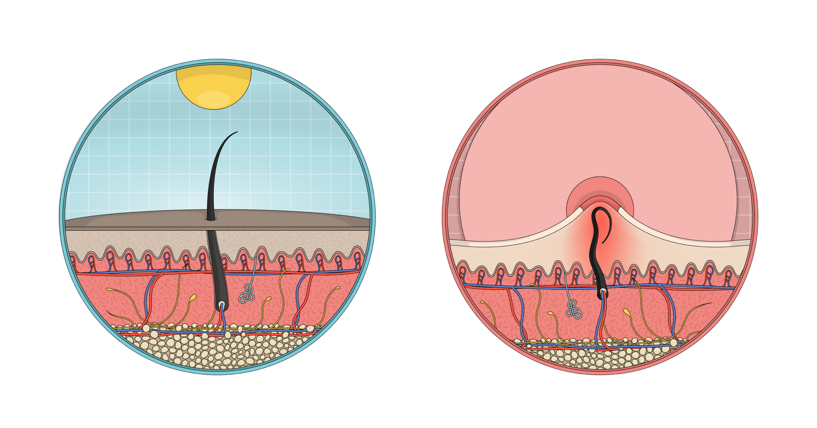 What Causes Ingrown Hair? | How to Treat Ingrown Hair | Soft Services ...