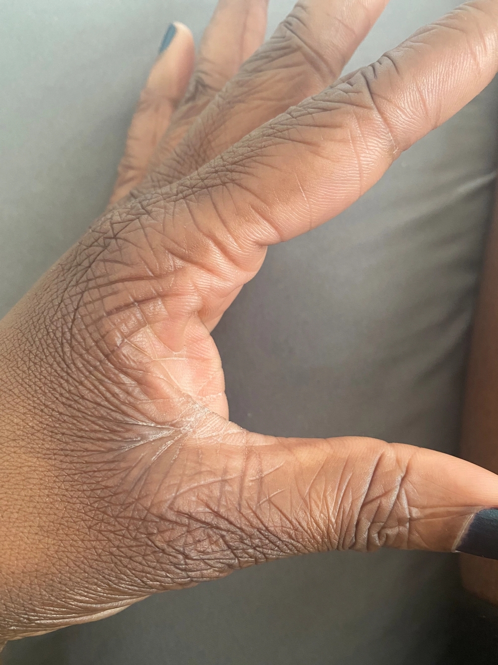 Dry Skin Image Gallery—Pictures on Hands, Legs | Soft Services | the ...