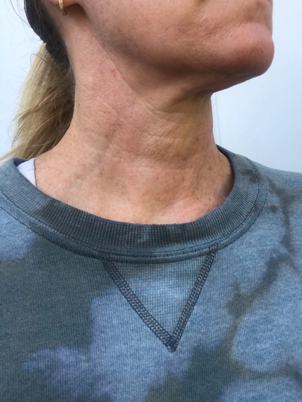 Crepey Skin Gallery—Pictures on Arms, Chest, Hands, Legs | Soft ...