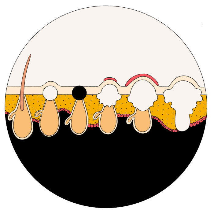 Should you moisturize your back for back acne? | Soft Services | the ...
