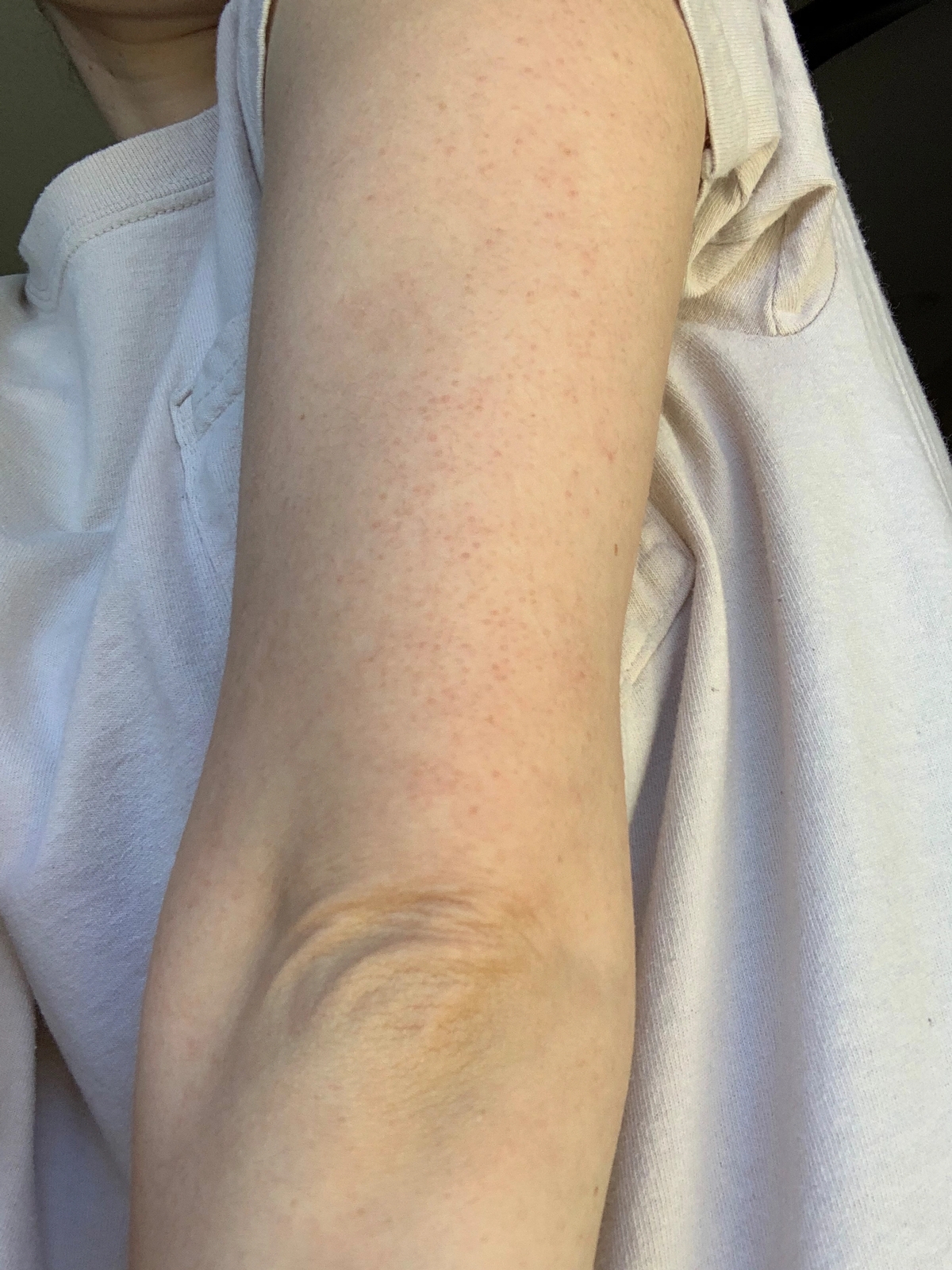 Keratosis Pilaris Image Gallery—Pictures on Arms, Legs | Soft Services ...