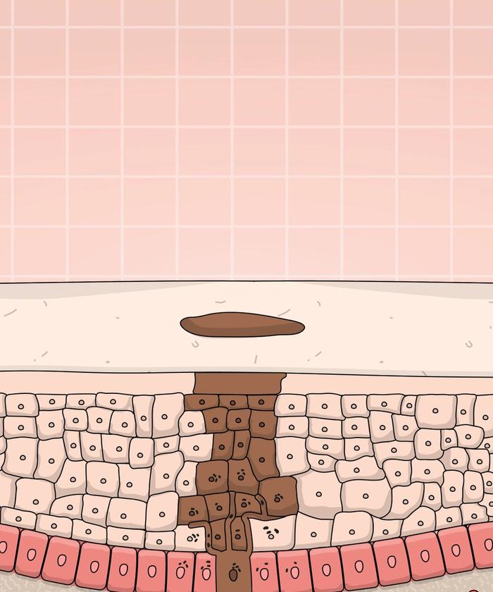 How Do You Get Rid Of Acne Hyperpigmentation? | Skin Discoloration ...