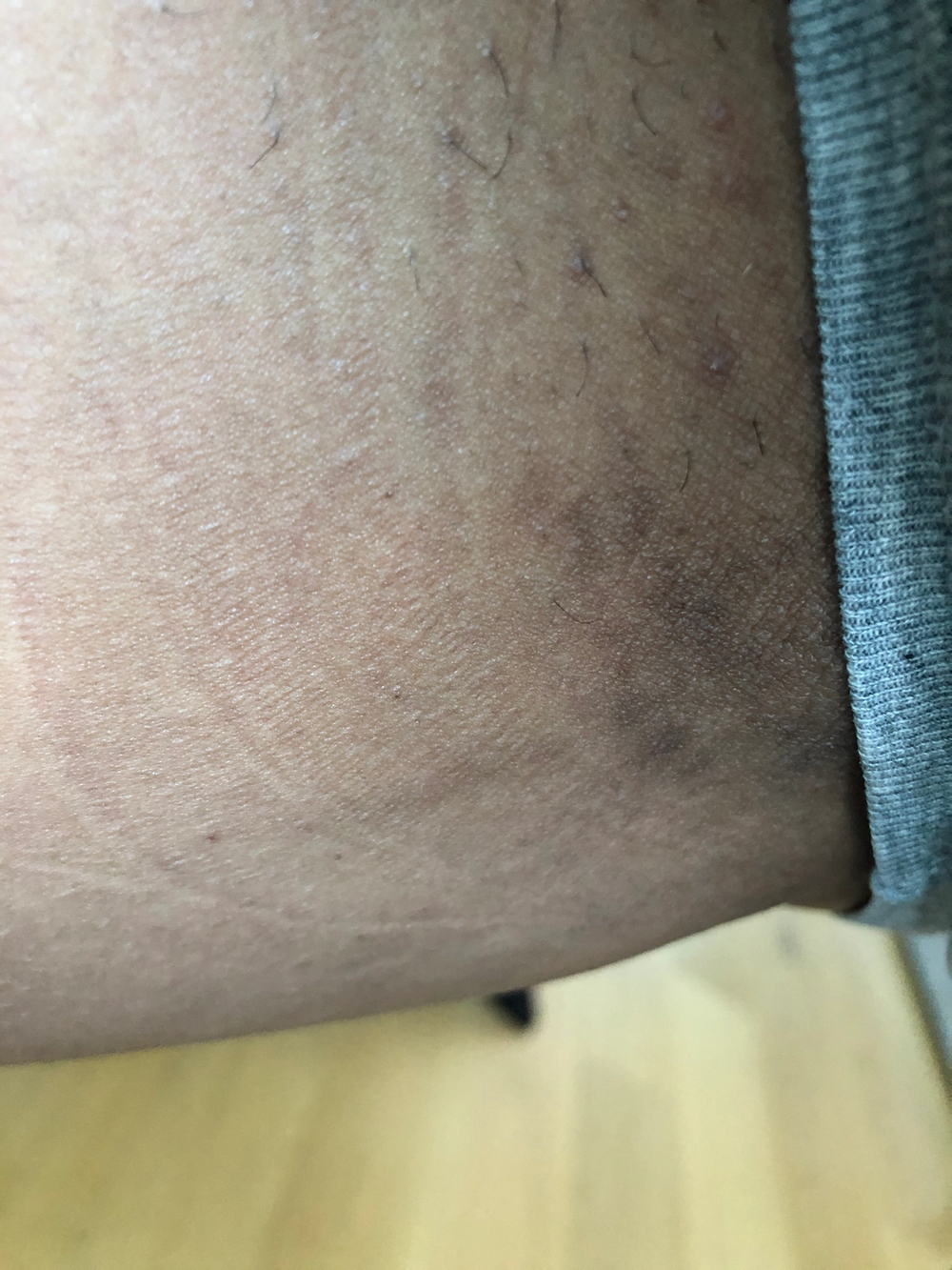 Ingrown Hair Image Gallery—Pictures on Body | Soft Services | the body ...
