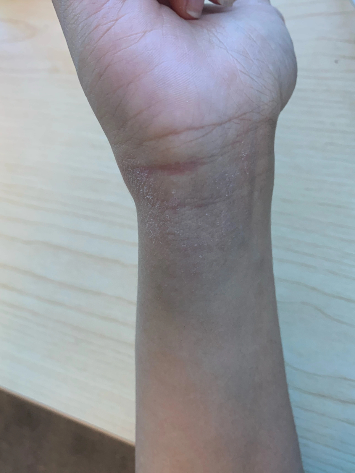 Dry Skin Image Gallery—Pictures on Hands, Legs | Soft Services | the ...