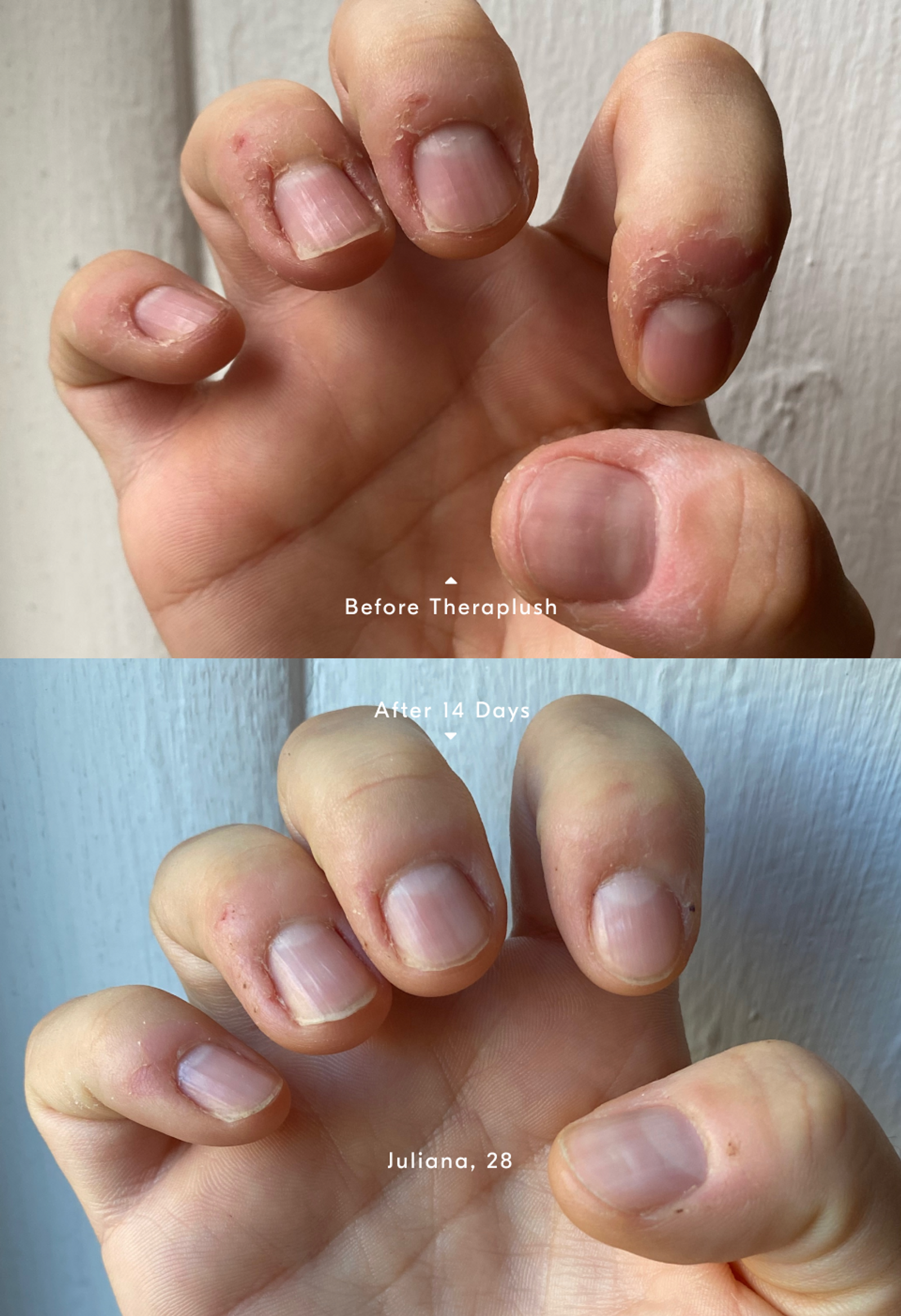 How to treat flaky, peeling, dry cuticles? | Soft Services | the body ...
