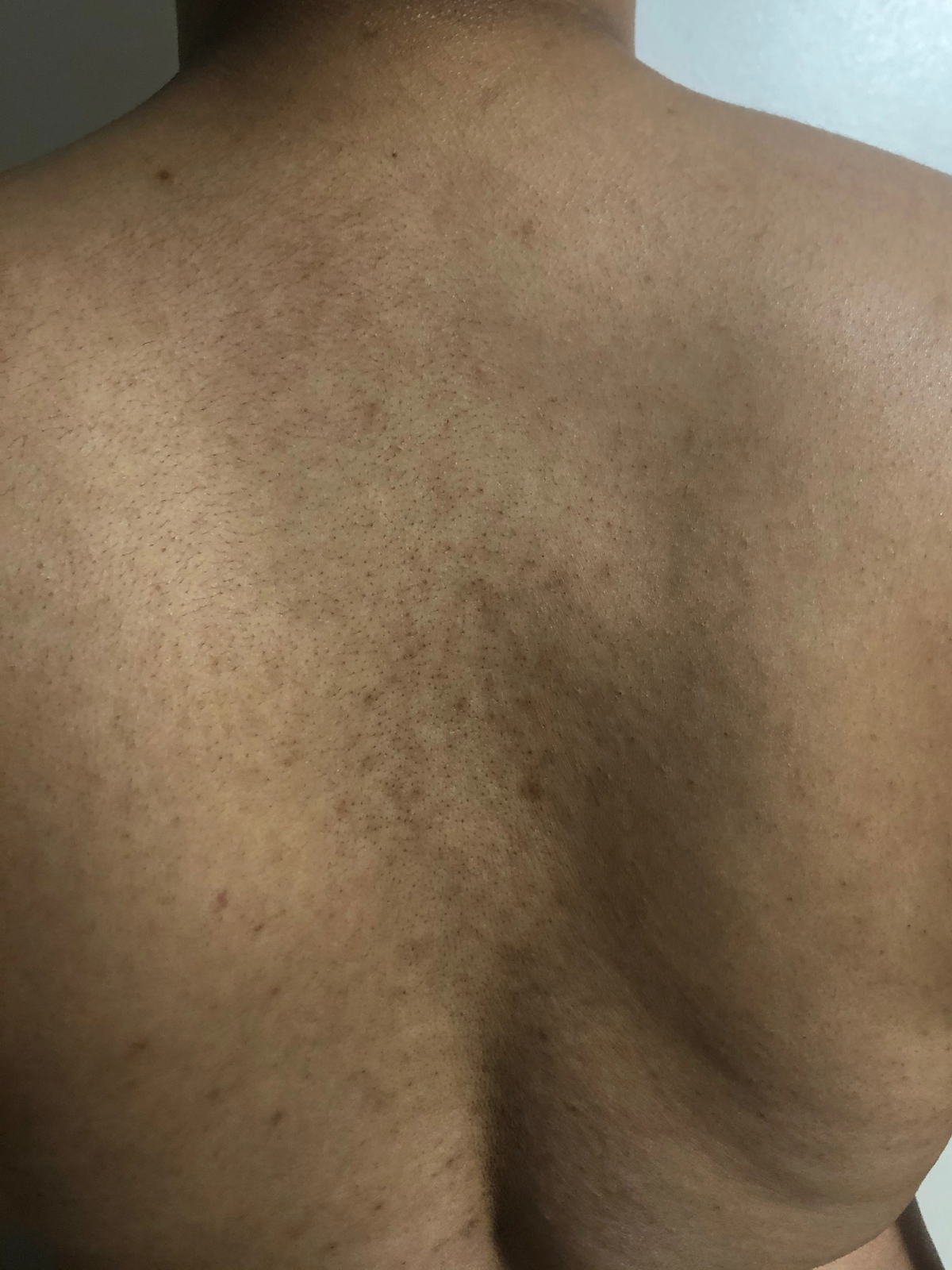 Tinea Versicolor Gallery—Pictures on Back, Chest, Butt | Soft Services ...