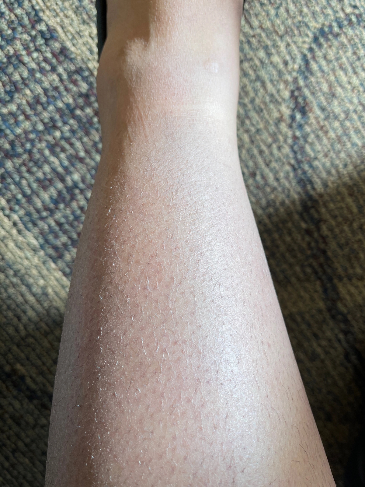 Dry Skin Image Gallery—Pictures on Hands, Legs | Soft Services | the ...