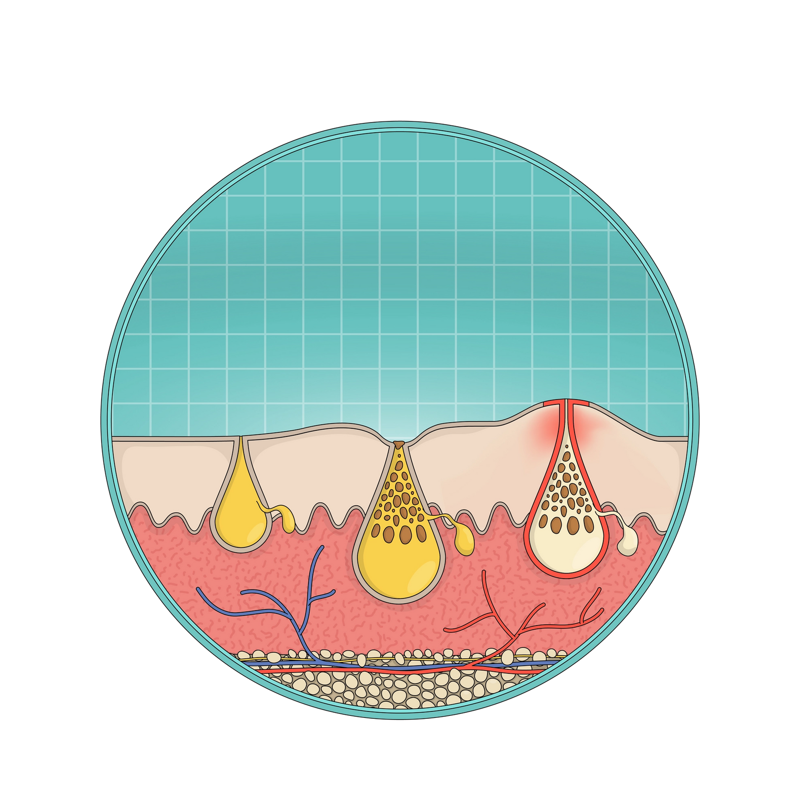 What are Clogged Pores? | How to Get Rid of Clogged Pores | Soft ...