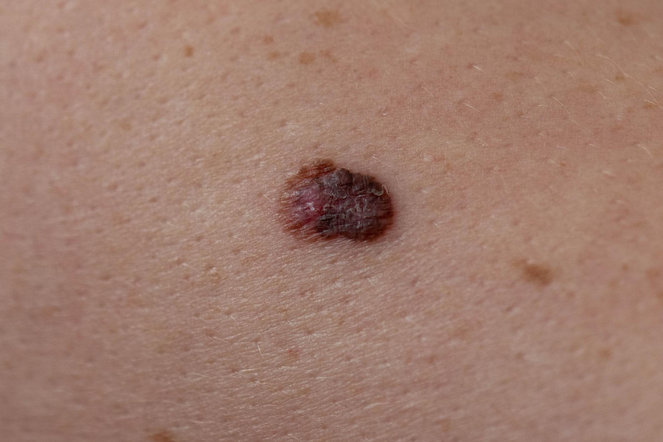 What is Nodular Melanoma?