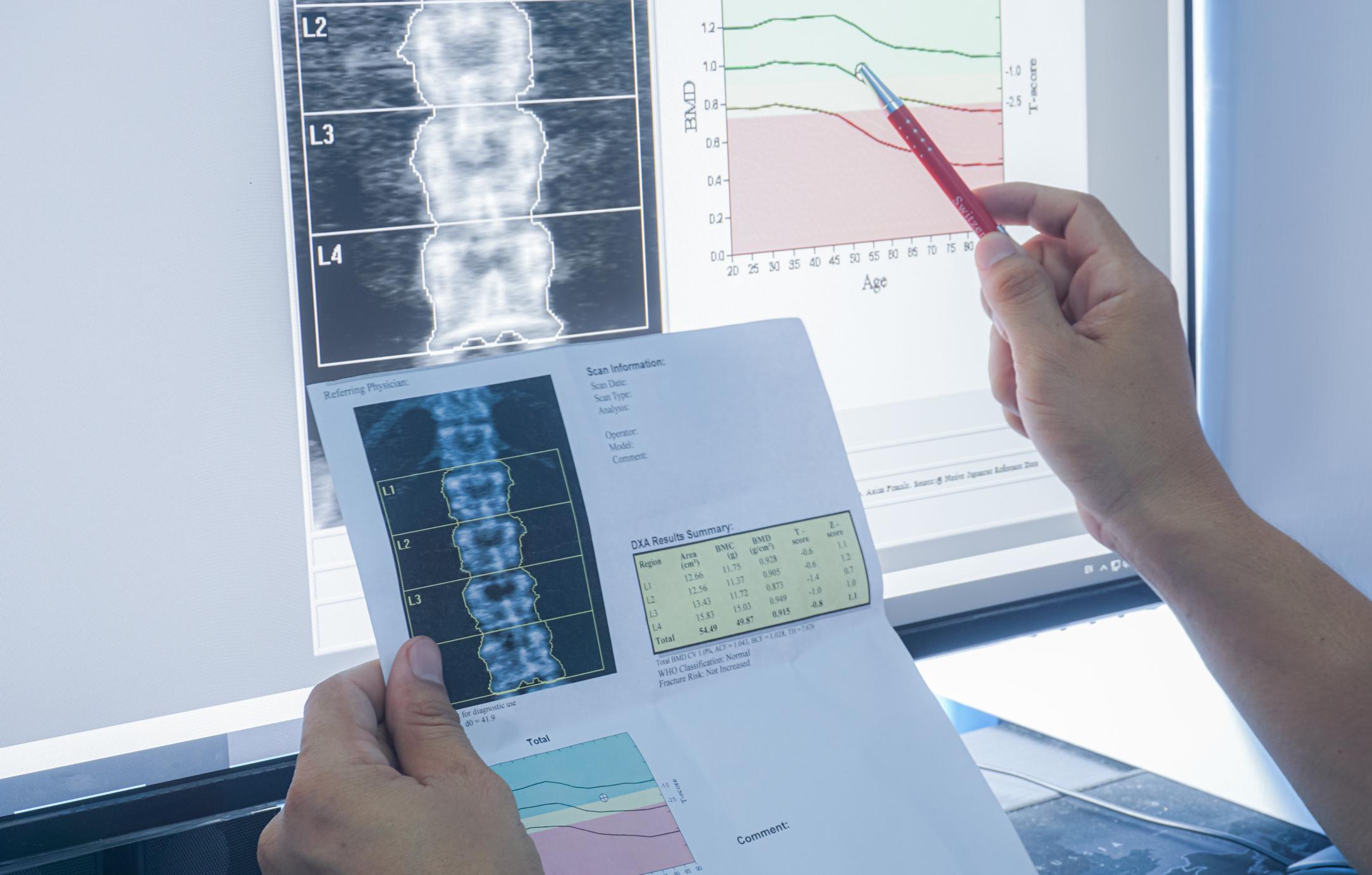 Osteoporosis Screening: What You Need to Know