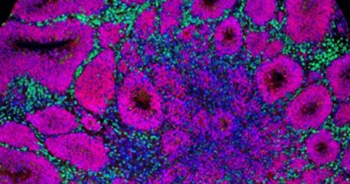 Different autism risk genes, same effects on brain development