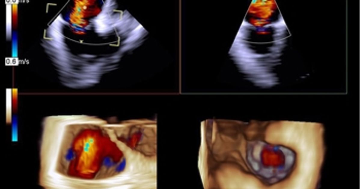 Siemens Healthineers has received CE Mark for the ACUSON AcuNav Volume ...