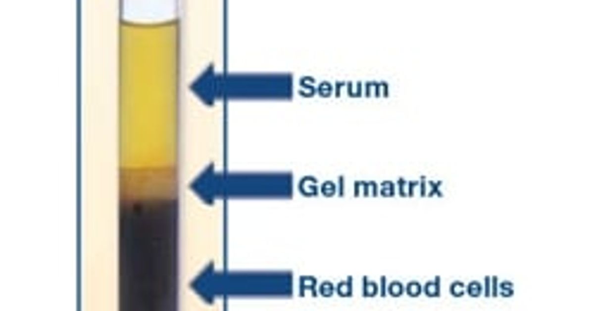 Recovery of Serum Directly from Serum Separator Tubes (SST) for Viral ...