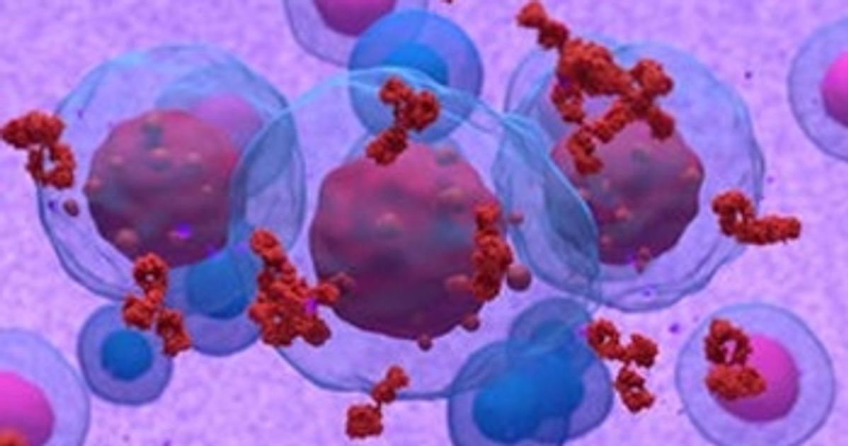 Understanding the link between MGUS and multiple myeloma: an expert view