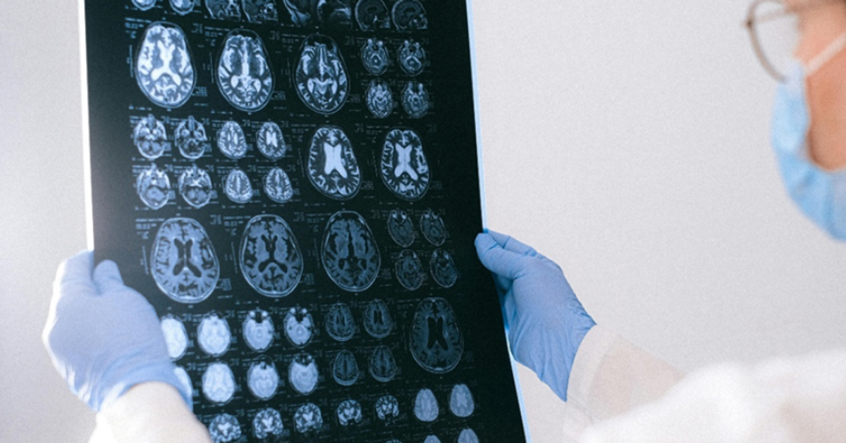 Aptamer Group and Neuro-Bio advance Alzheimer’s test and agree royalties