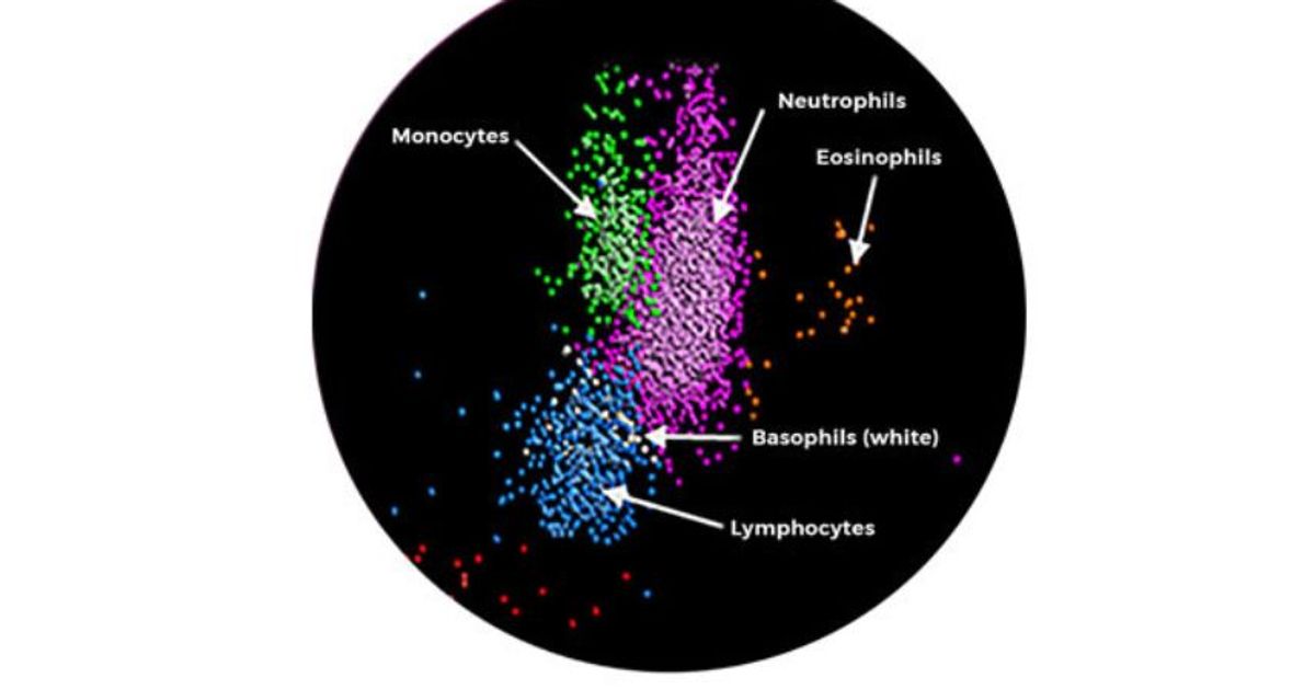 Monocyte Distribution Width Sepsis Risk Marker | SelectScience