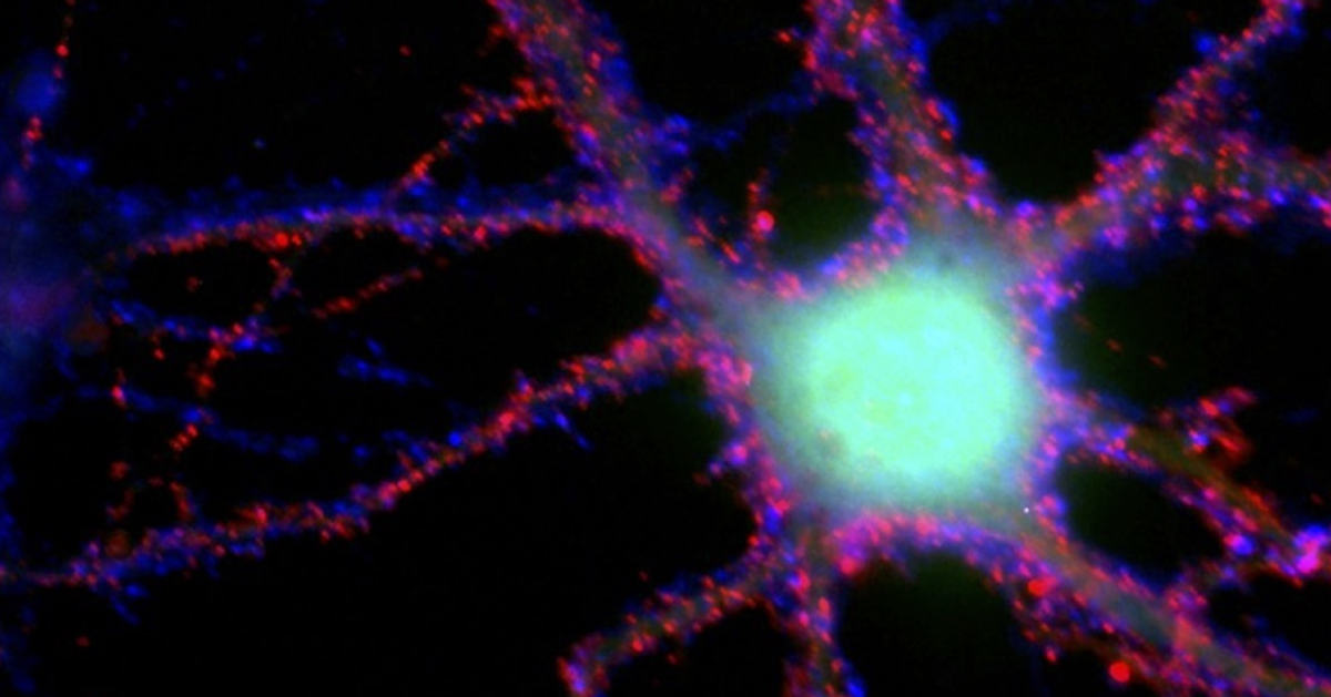 Study links rare genetic mutation to severe neurological disorder