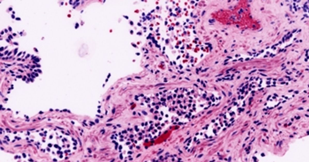 New Optical Method “Cuts” and Examines Cancer Biopsies During Surgery