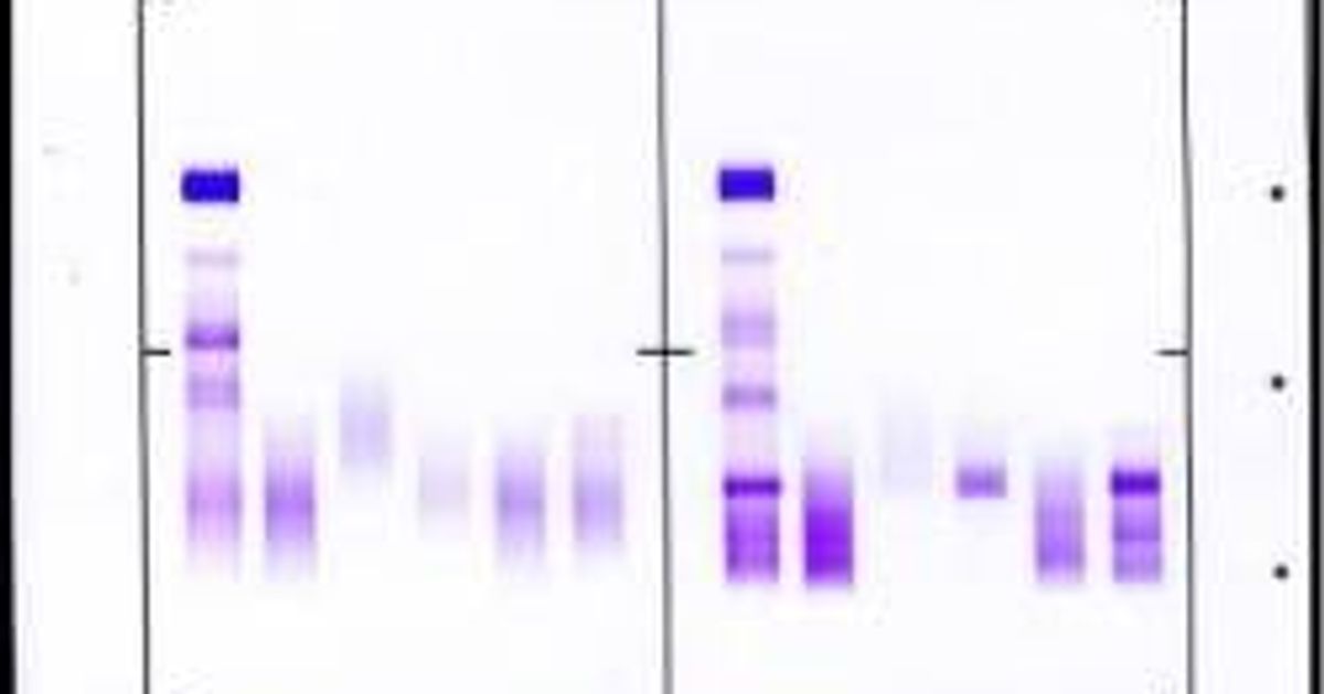 New electrophoresis High Resolution Immunofixation using Hydragel kit ...