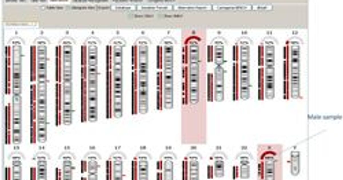 Unique CNV Array with Whole Chromosome Uniparental Disomy (UPD) Detection from OGT