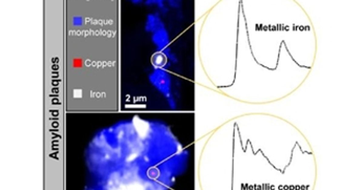 Discovery of microscopic metallic particles in the human brain