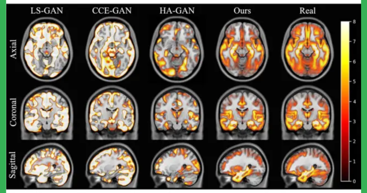 AI brain images create realistic synthetic data to use in medical research