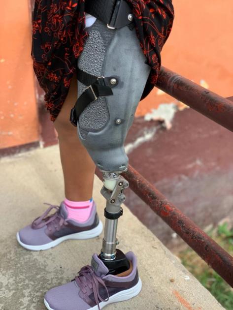 World's most advanced prosthetics in Guatemala | nTop