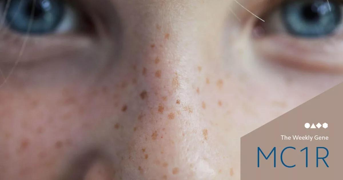 The genetics of a freckle | Helix