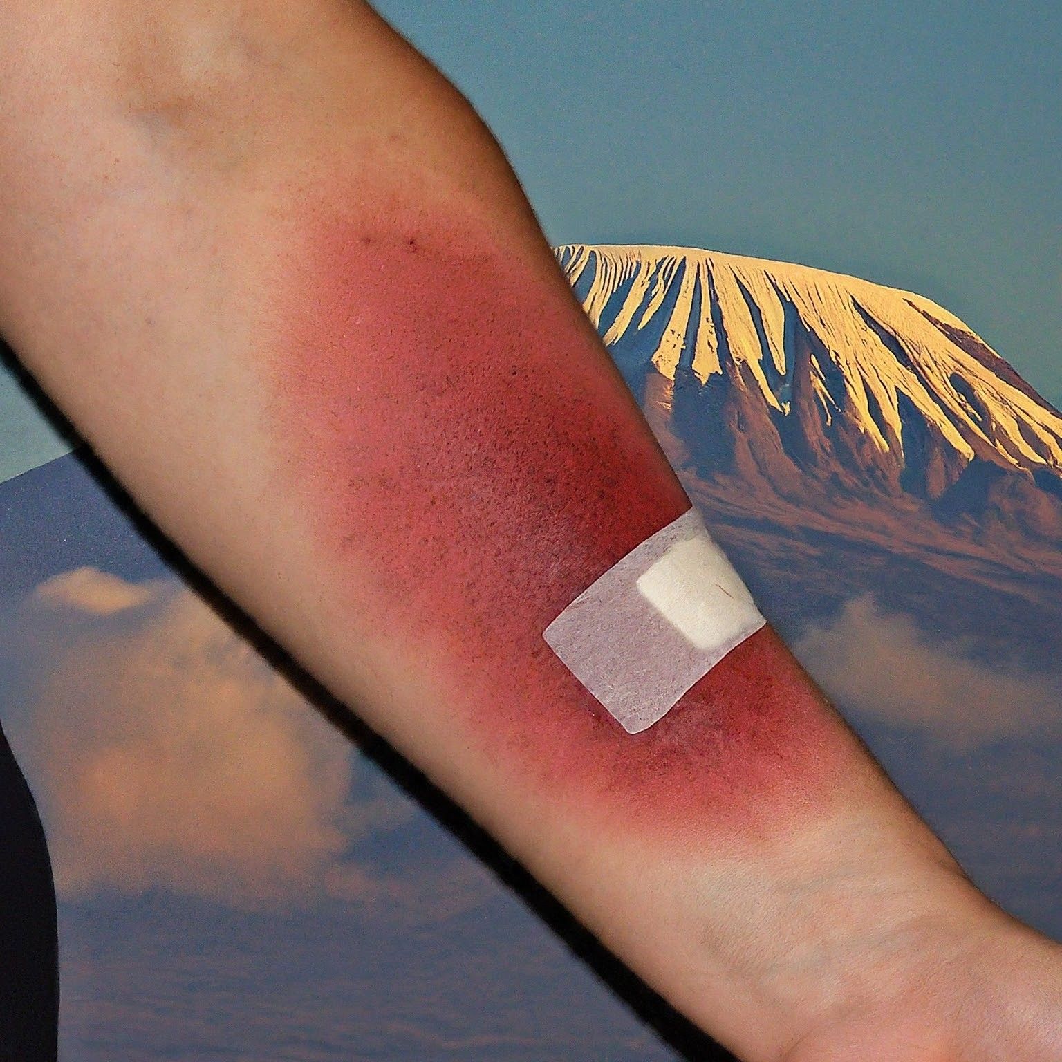 Mounjaro Rash & Hives: Symptoms, Pictures, and Relief