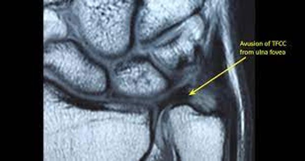 Triangular Fibrocartilage Complex Tfcc Wrist Injuries