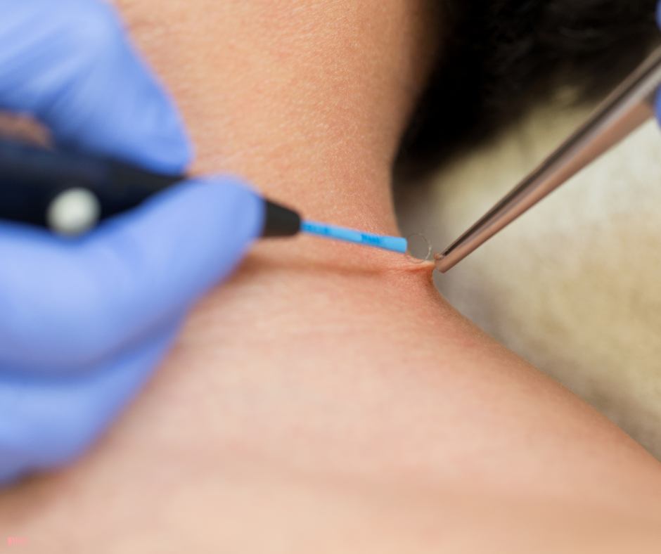 Say Goodbye to Skin Tags: Effective Remedies and Expert Advice | The ...