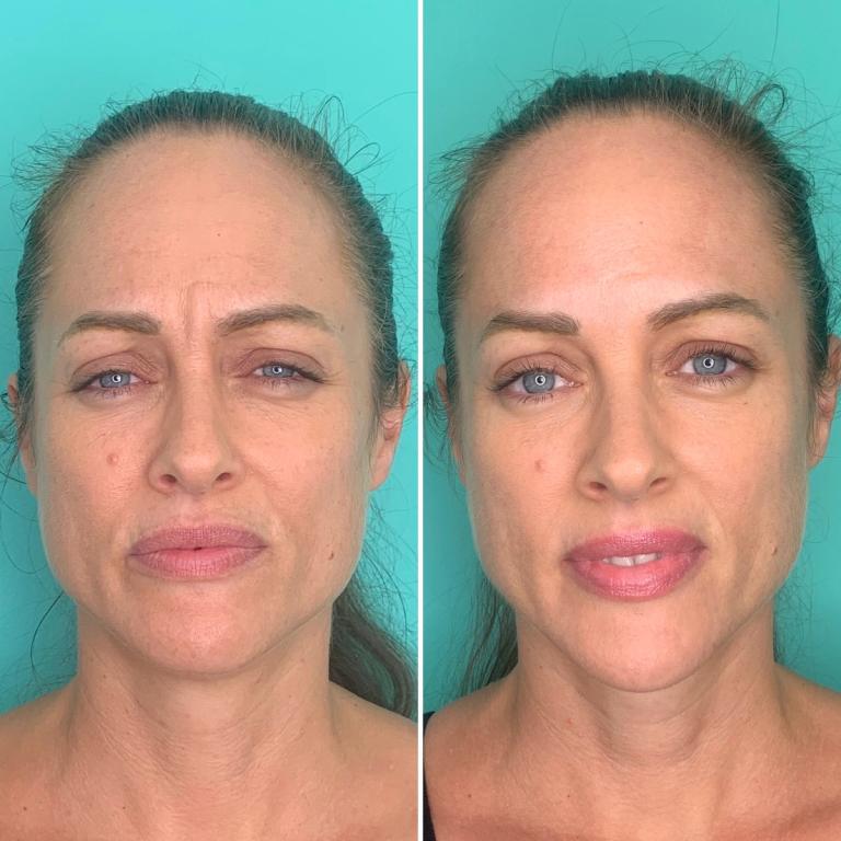 Will Botox Make Me Look Weird? | Glowday