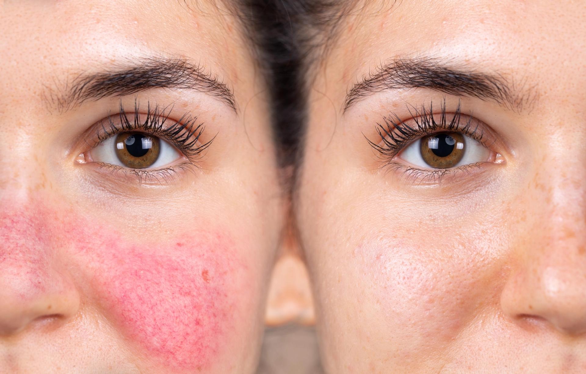 Rosacea - What is it, and how do you treat it? | Glowday
