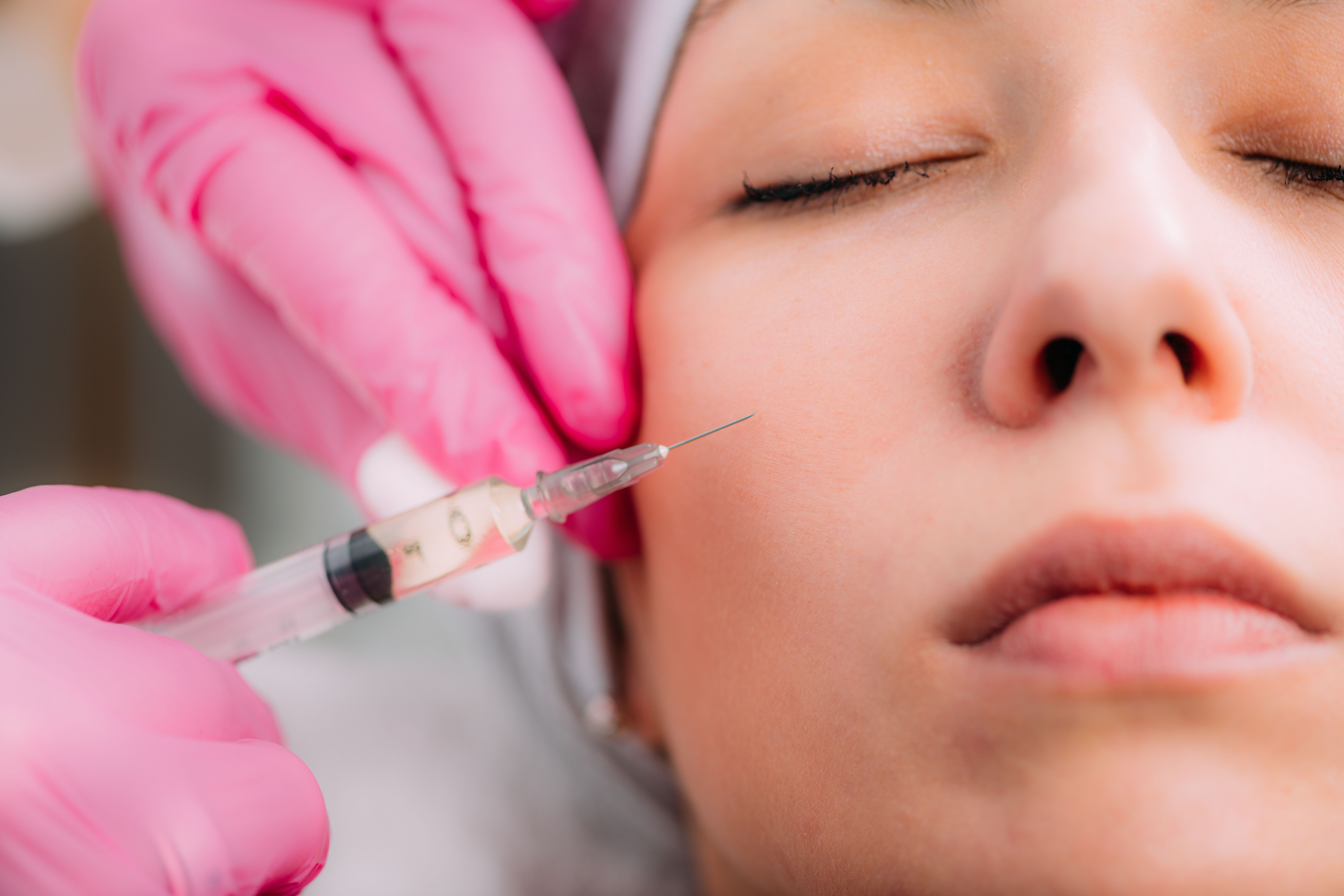 Cheek Fillers for Midface Rejuvenation | Glowday