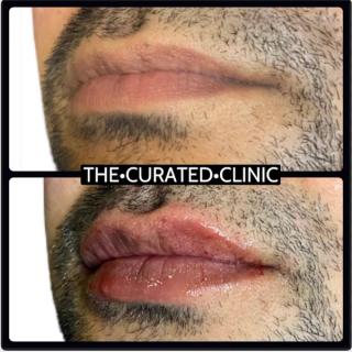 The Rise and Rise of Lip Fillers for Men | Glowday