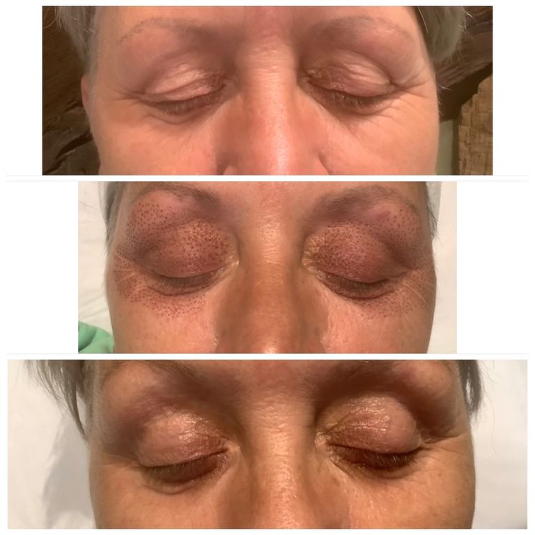 Best Treatment For Heavy Eyelids, Loose Skin and Eye Bags. | Glowday