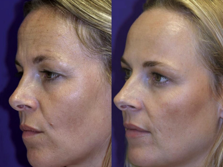 Twins Study Reveals the Power of Botox for Youthful Skin | Glowday