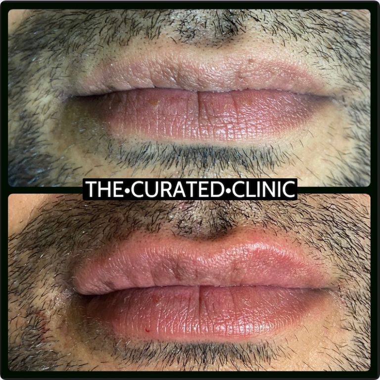 The Rise and Rise of Lip Fillers for Men | Glowday