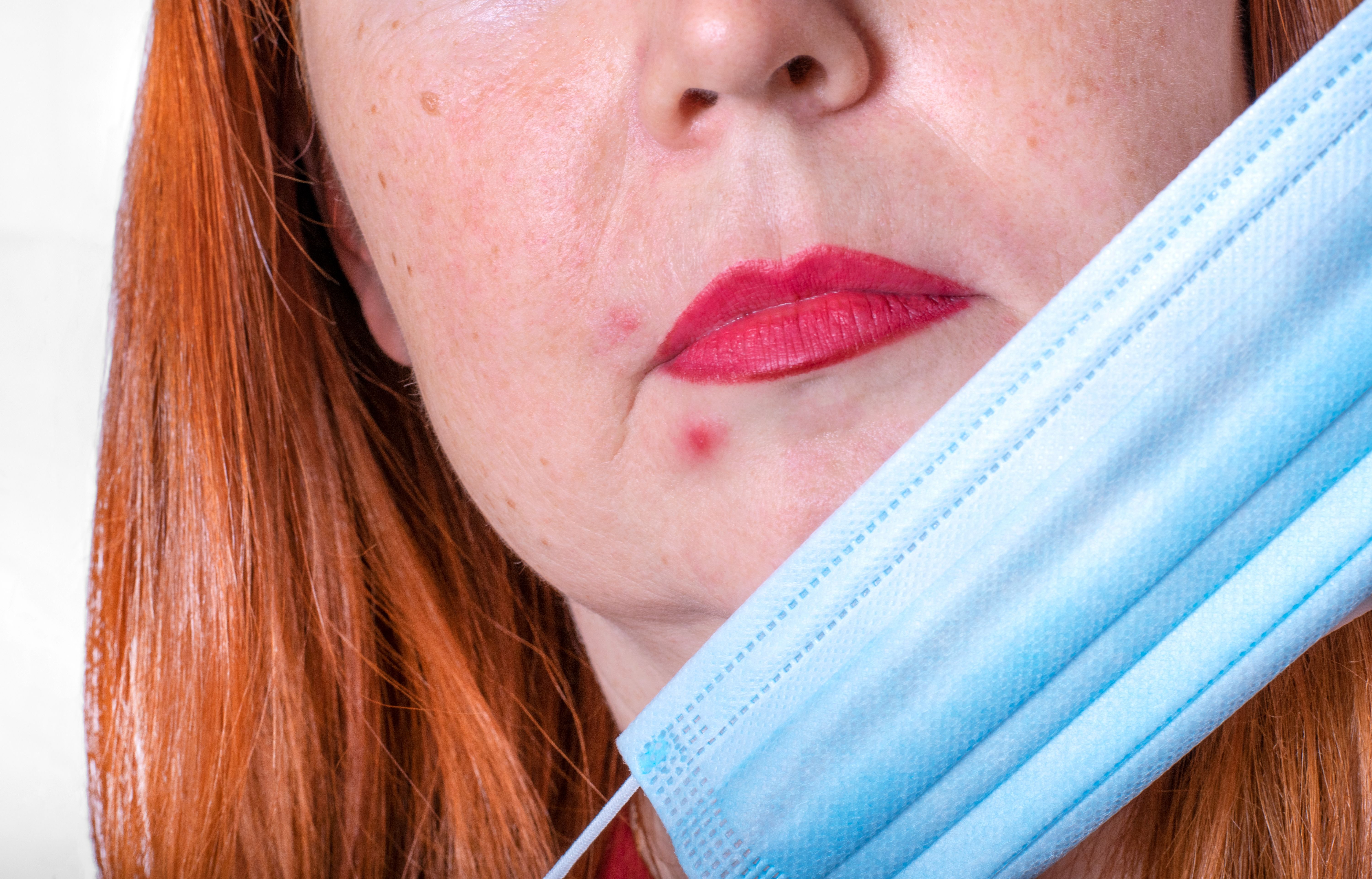 Spotty Chin and Mouth: The Return of Maskne | Glowday