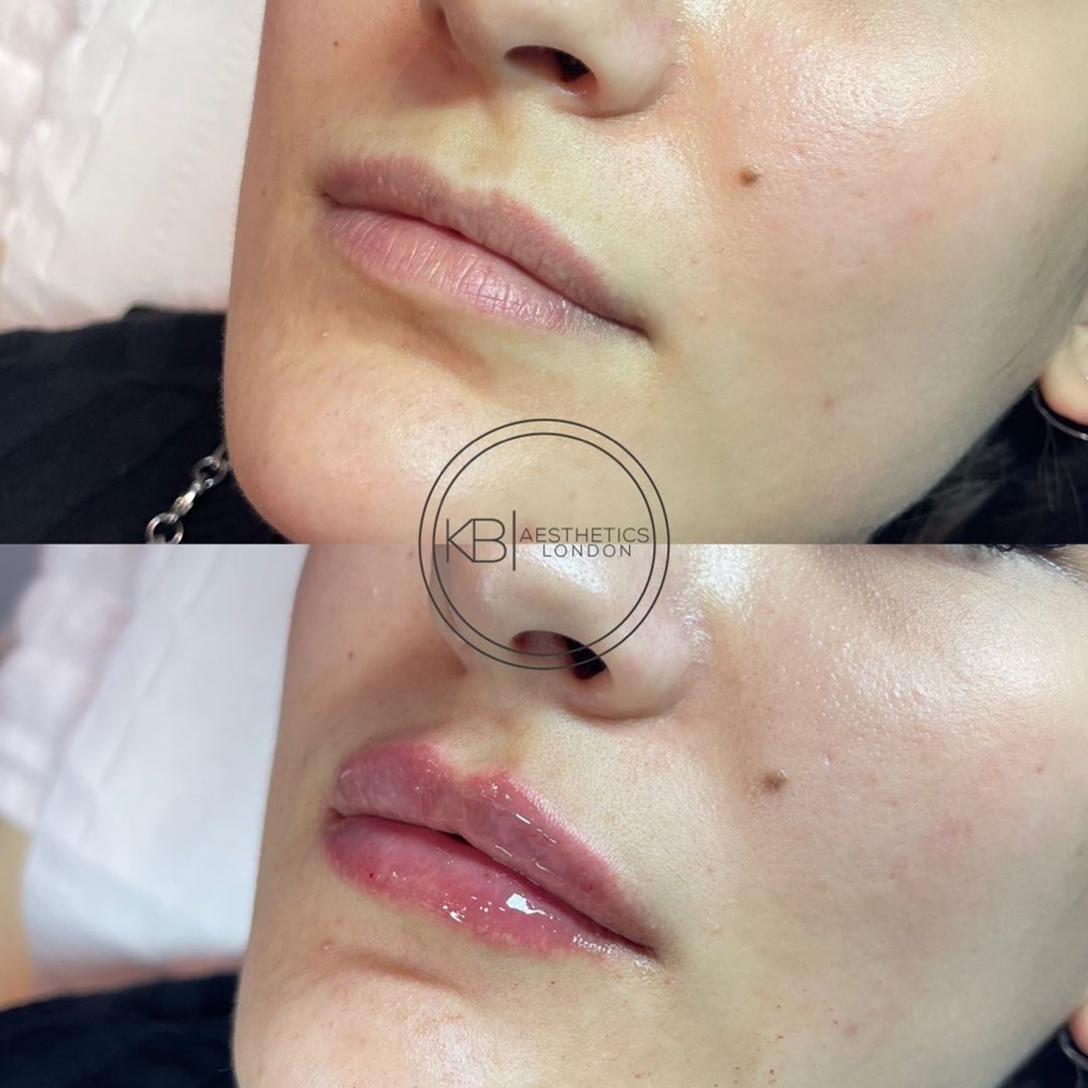 How Do Fillers Work? | Glowday