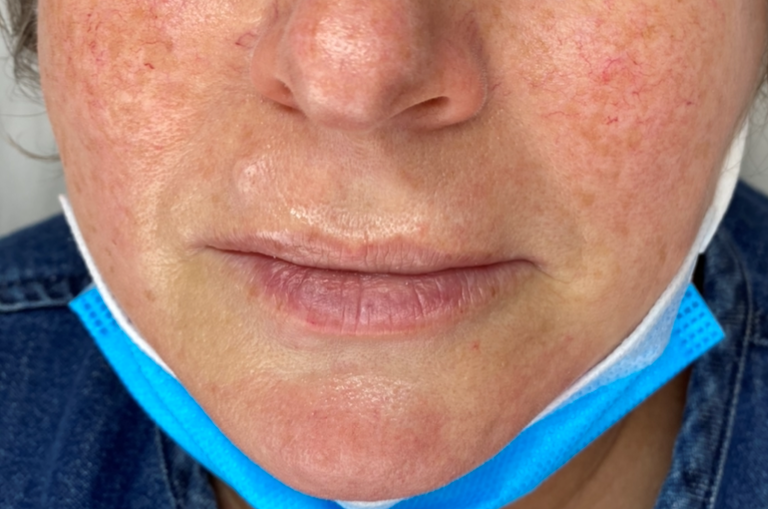 Tweakments After a Stroke: How Botox and Fillers Helped with Asymmetry ...