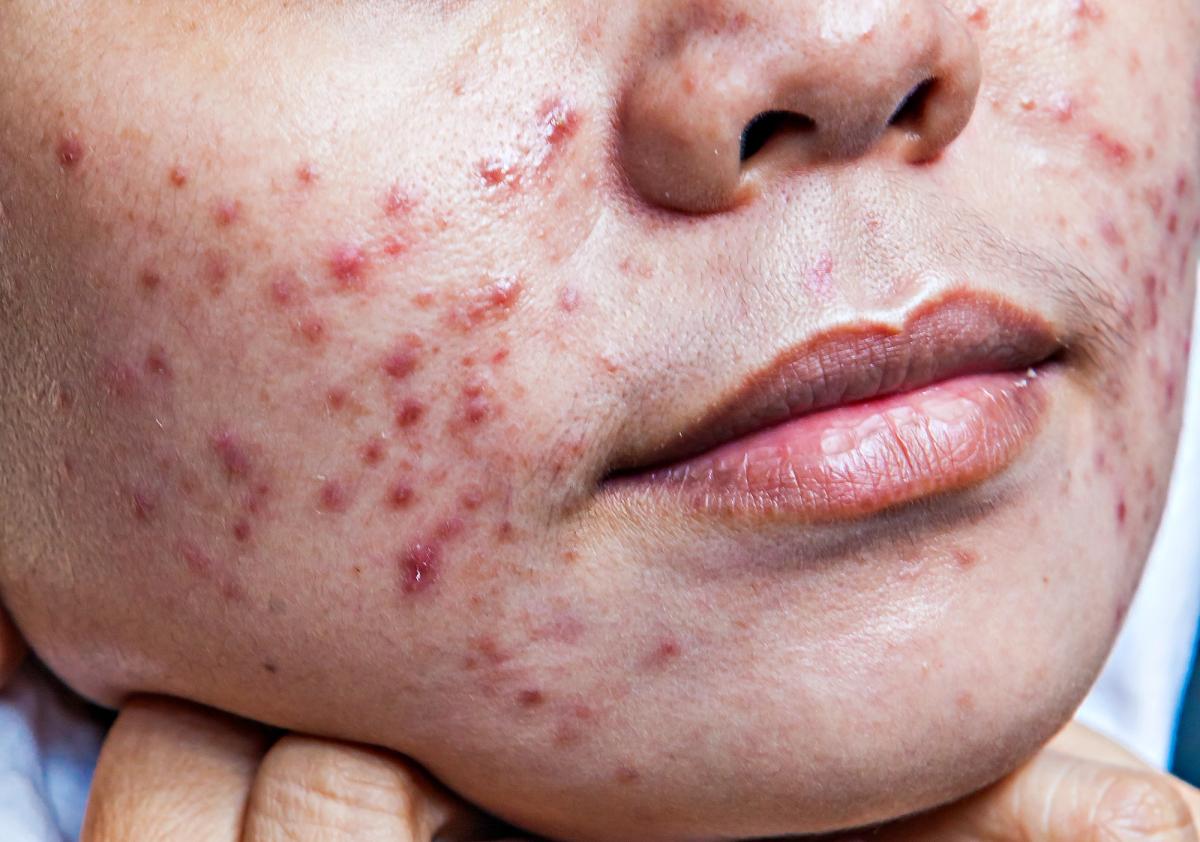 How to Treat Cystic Acne | Glowday