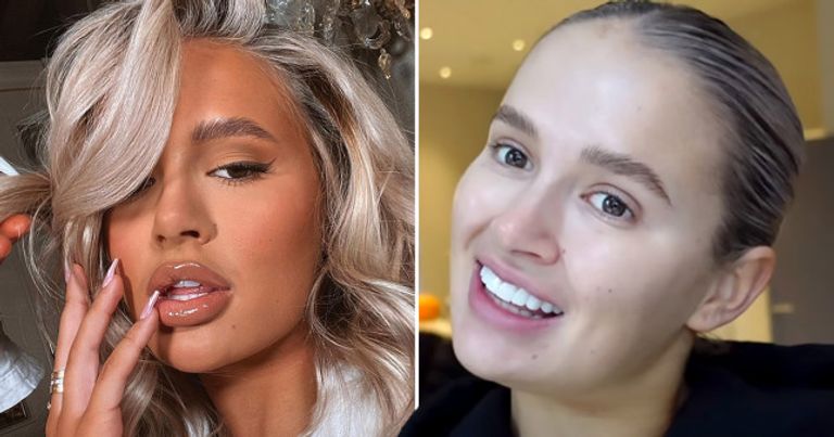 Love Island, Lip Fillers and Botox | Glowday