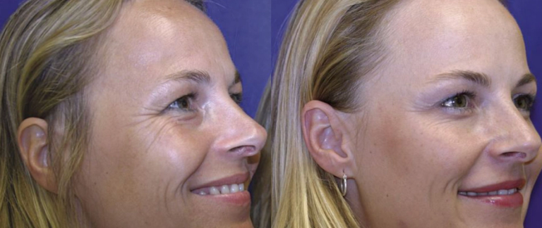 Twins Study Reveals the Power of Botox for Youthful Skin | Glowday